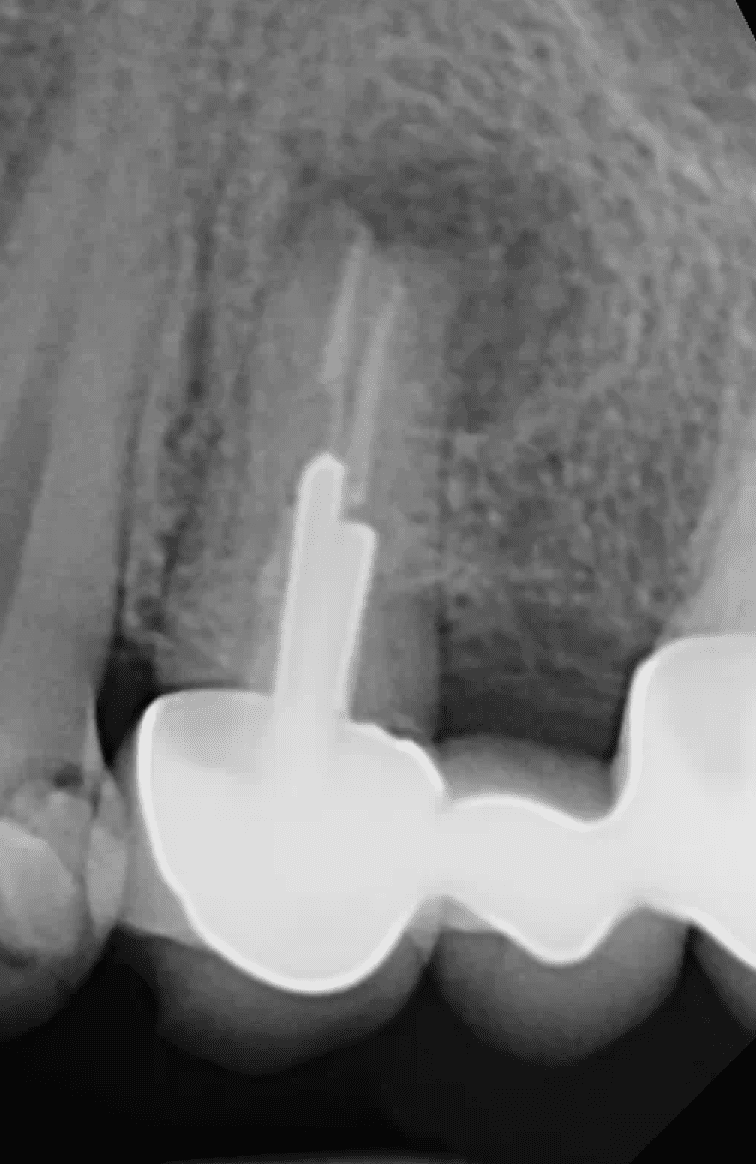 Endodontic Microsurgery - Mason Endodontics and Microsurgery