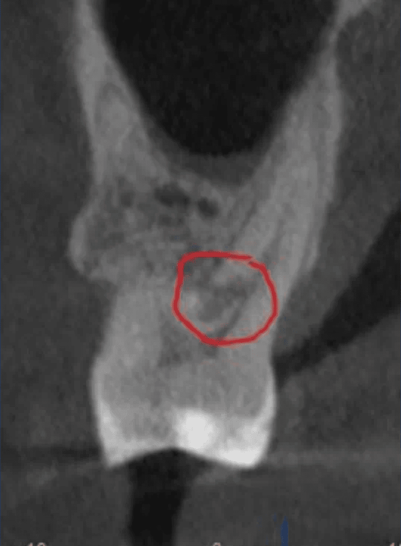 Root Resorption - Mason Endodontics and Microsurgery - Cincinnati Tooth ...